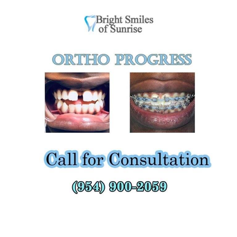Ortho progress | Dentist Oakland Park, FL