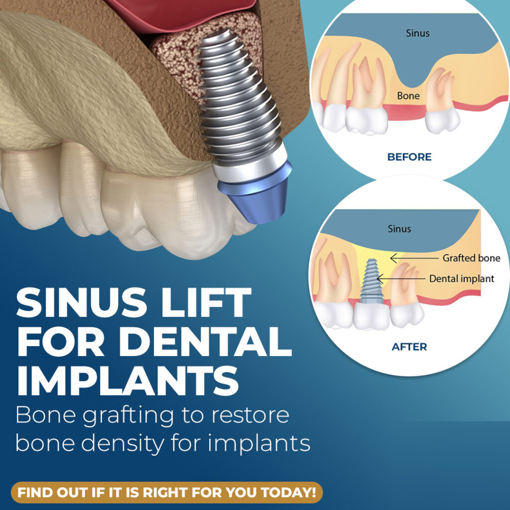 Sinus Lift for Dental Implants | Dentist Oakland Park, FL